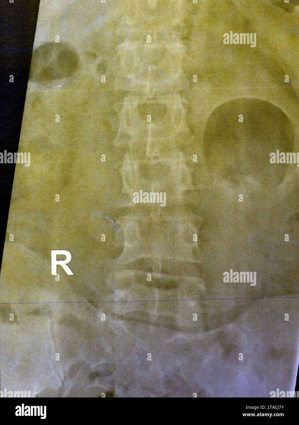 Plain X ray lumbosacral spine revealed straightened, mild scoliotic ...