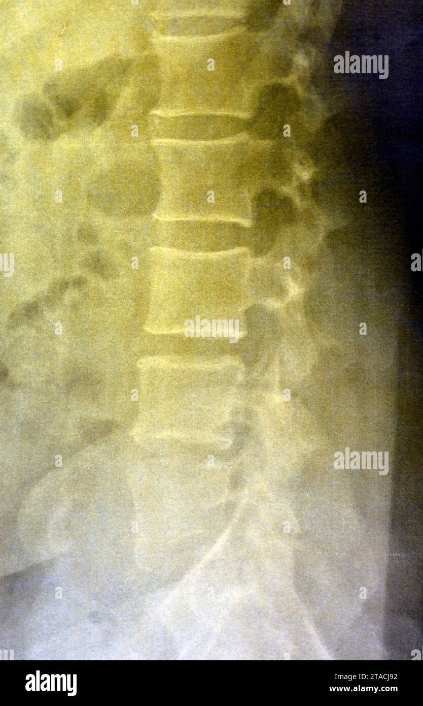 Plain X ray lumbosacral spine revealed straightened, mild scoliotic ...