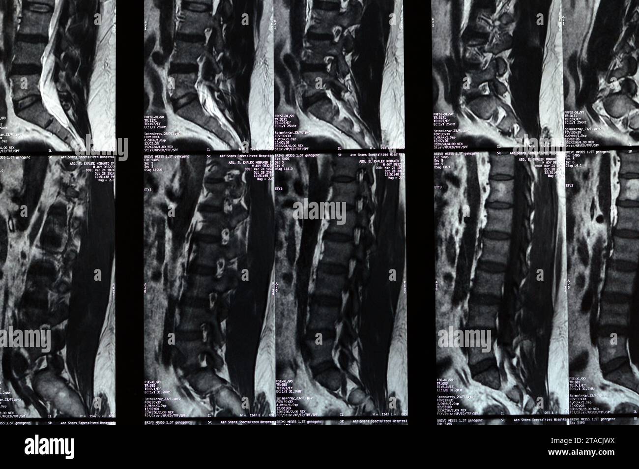 Cairo, Egypt, November 14 2023: MRI of lumbosacral spine revealed ...