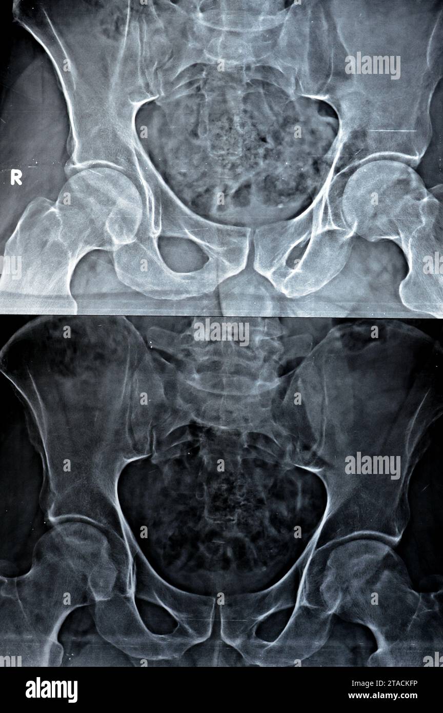 Plain X-ray of both hip joints revealed slight narrowing of ...