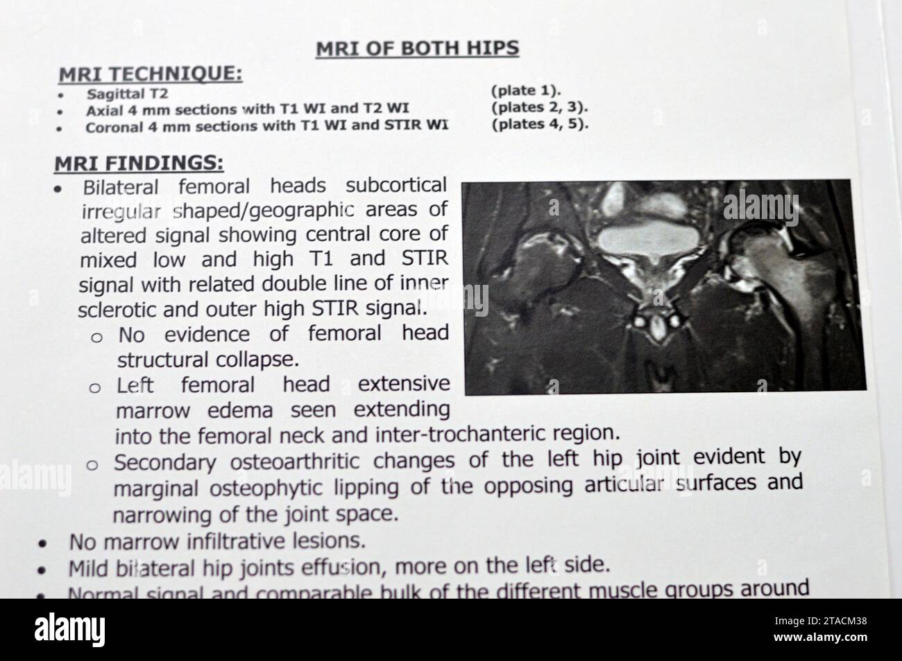 MRI of hip joints showing bilateral femoral head avascular necrosis ...