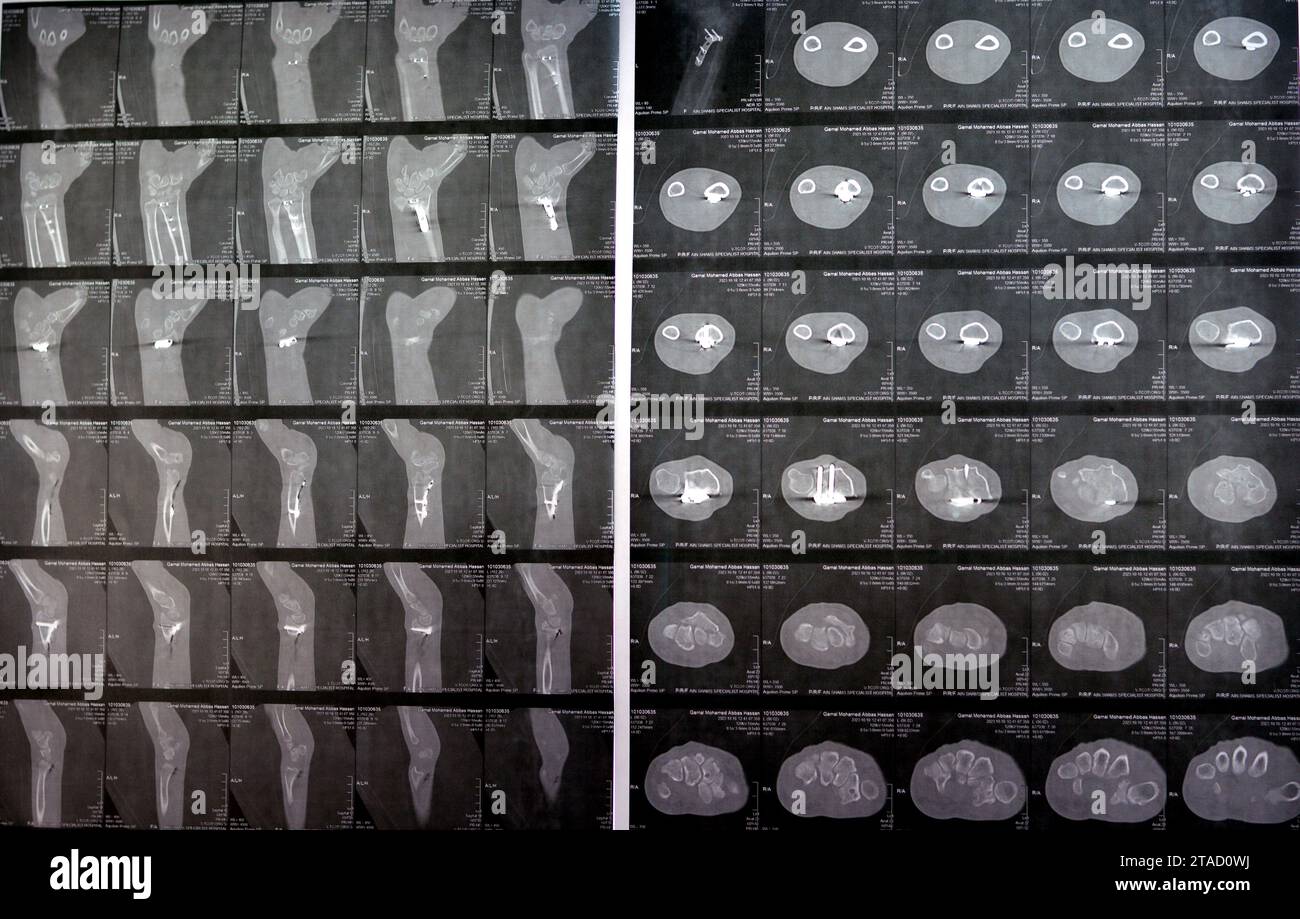 Cairo, Egypt, October 18 2023: CT scan left wrist joint showing a ...