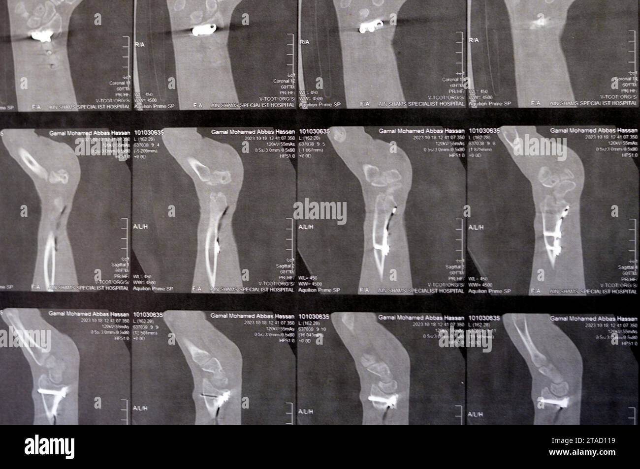 Cairo, Egypt, October 18 2023: CT scan left wrist joint showing a ...