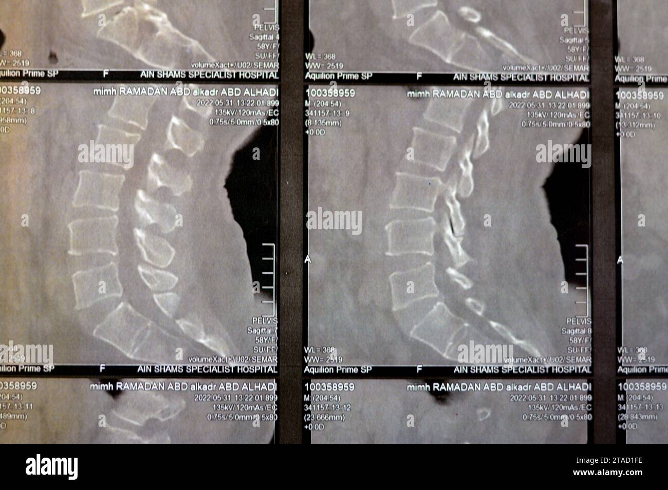 Cairo, Egypt, October 15 2023: CT scan of lumbo-sacral spine reveals ...
