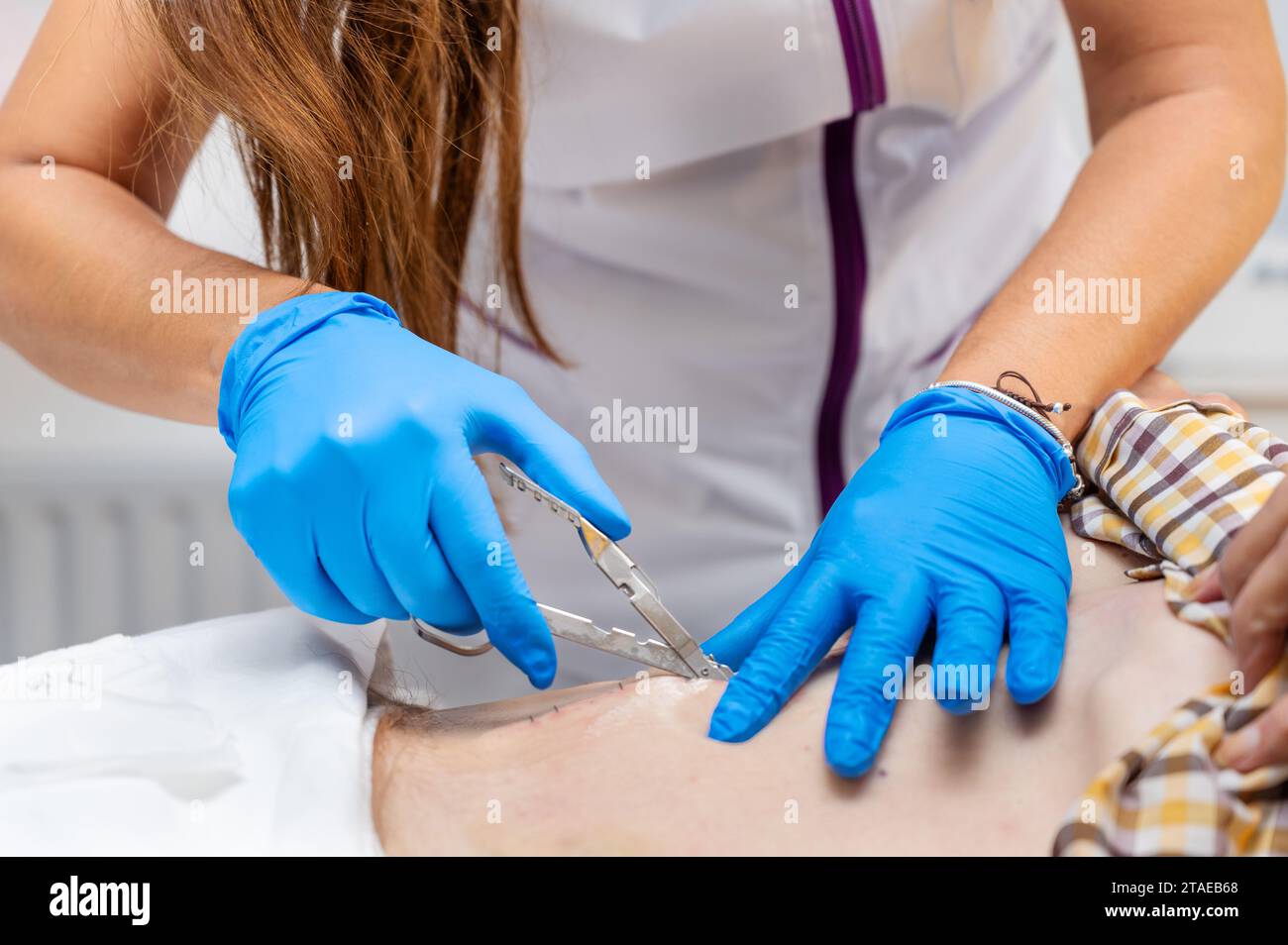 Nurse removing surgical stitches from the abdomen of a patient ...