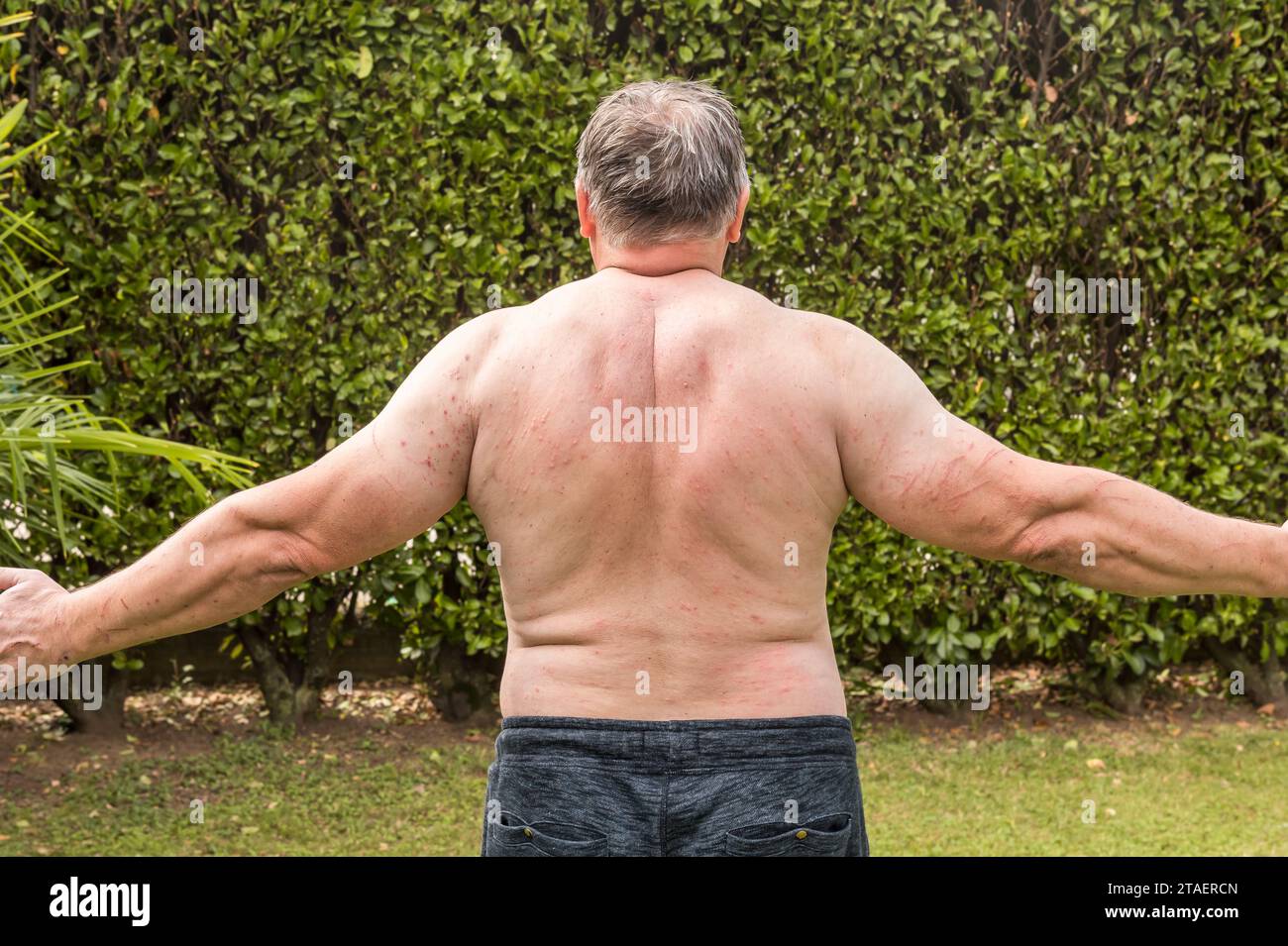 Back and arms of man with rash on, symptoms of itching, skin allergy ...