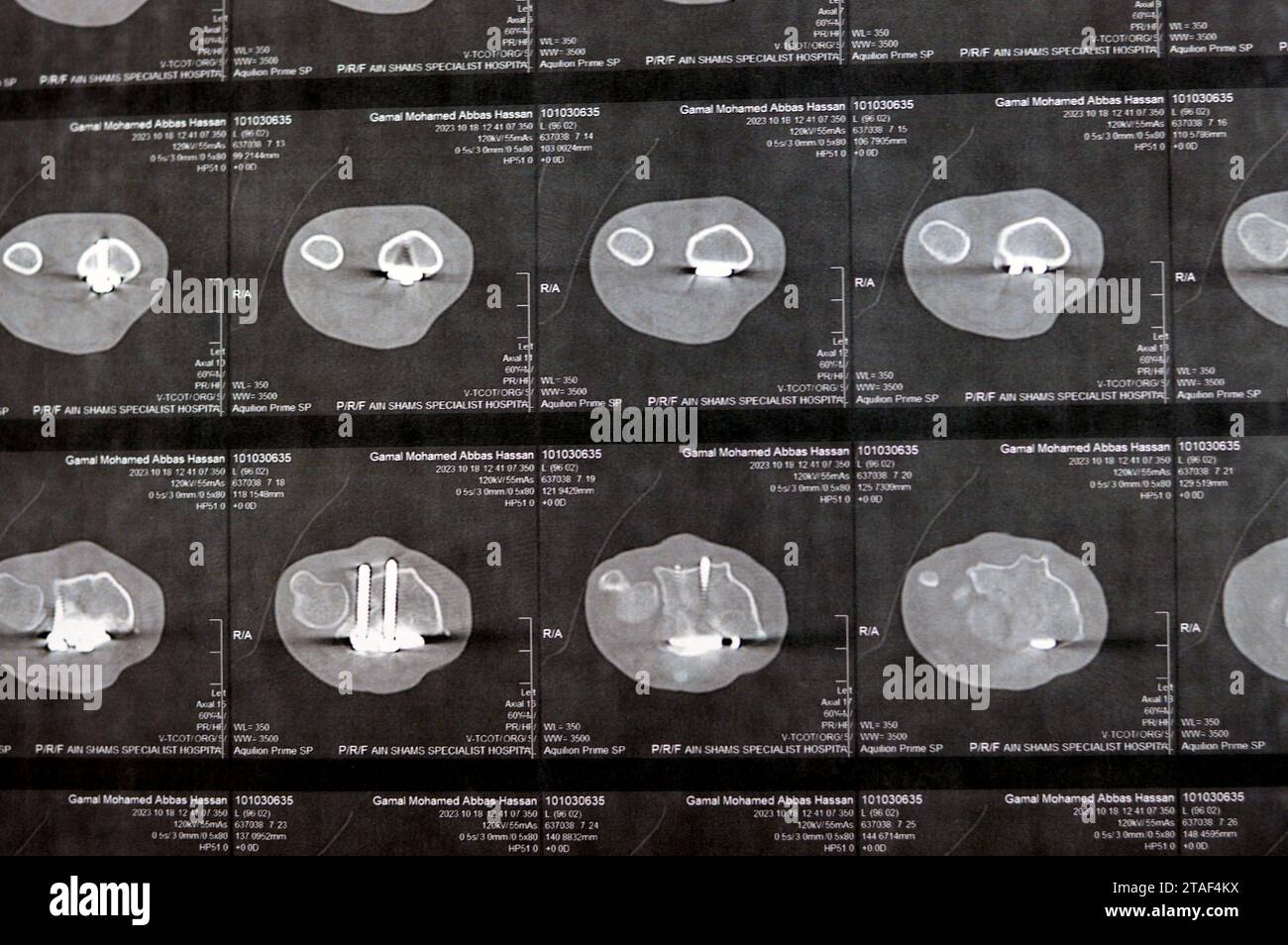 Cairo, Egypt, October 18 2023: CT scan left wrist joint showing a ...