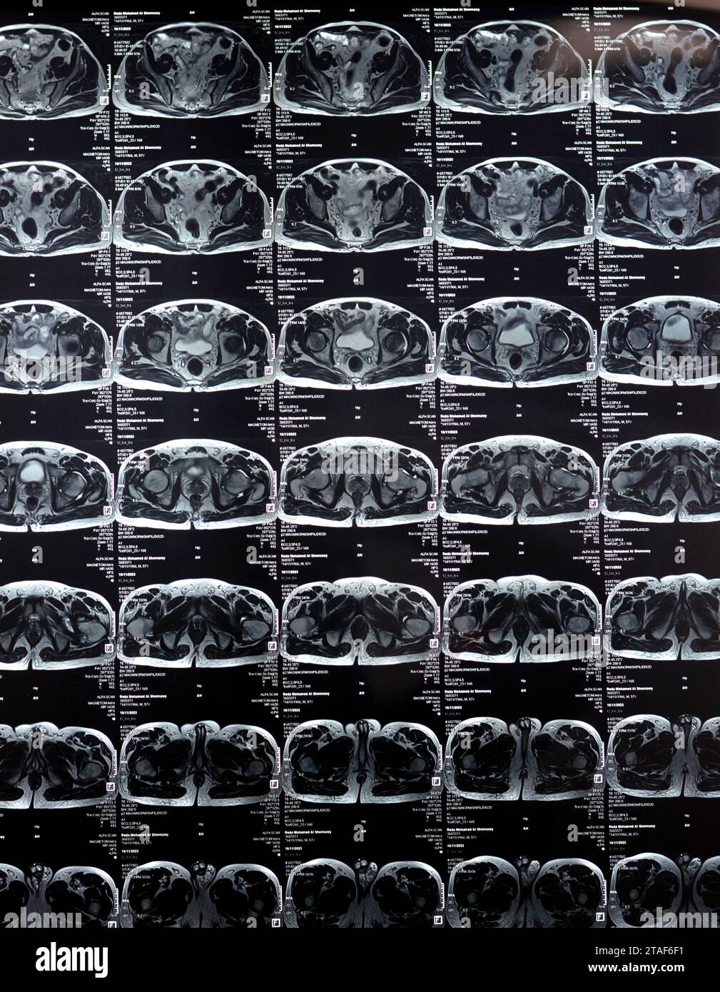 Cairo, Egypt, November 21 2023: MRI of hip joint showing bilateral ...