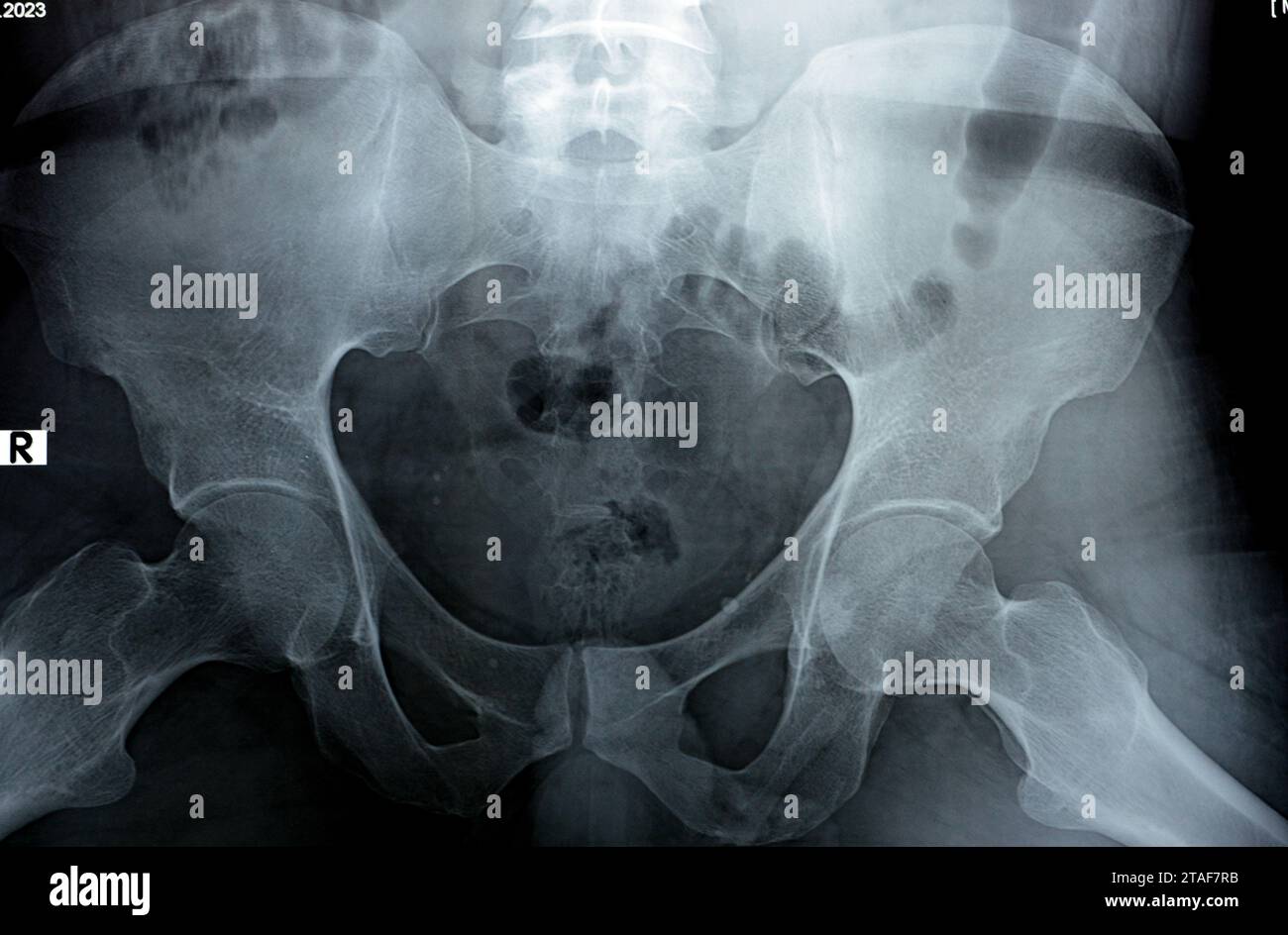 Hip joints digital radiographic examination reveals normal appearance ...