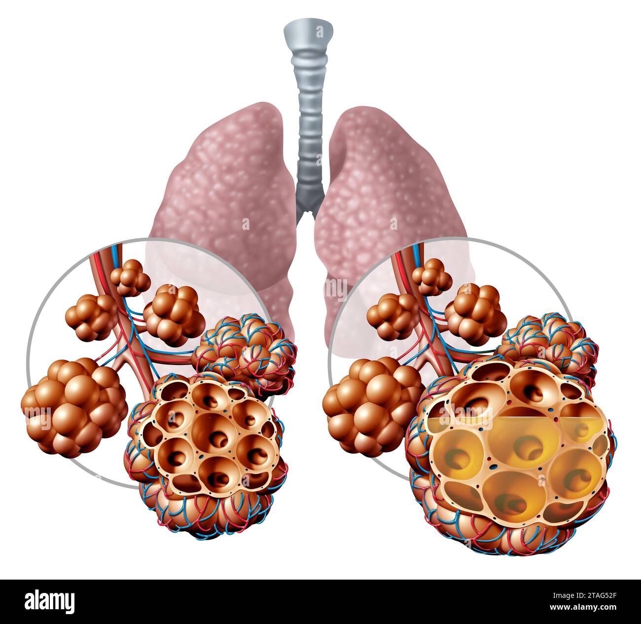 Pneumonia In The Lungs And Pulmonary Alveoli With Fluid Or Alveolus Inflammation Anatomy Diagram