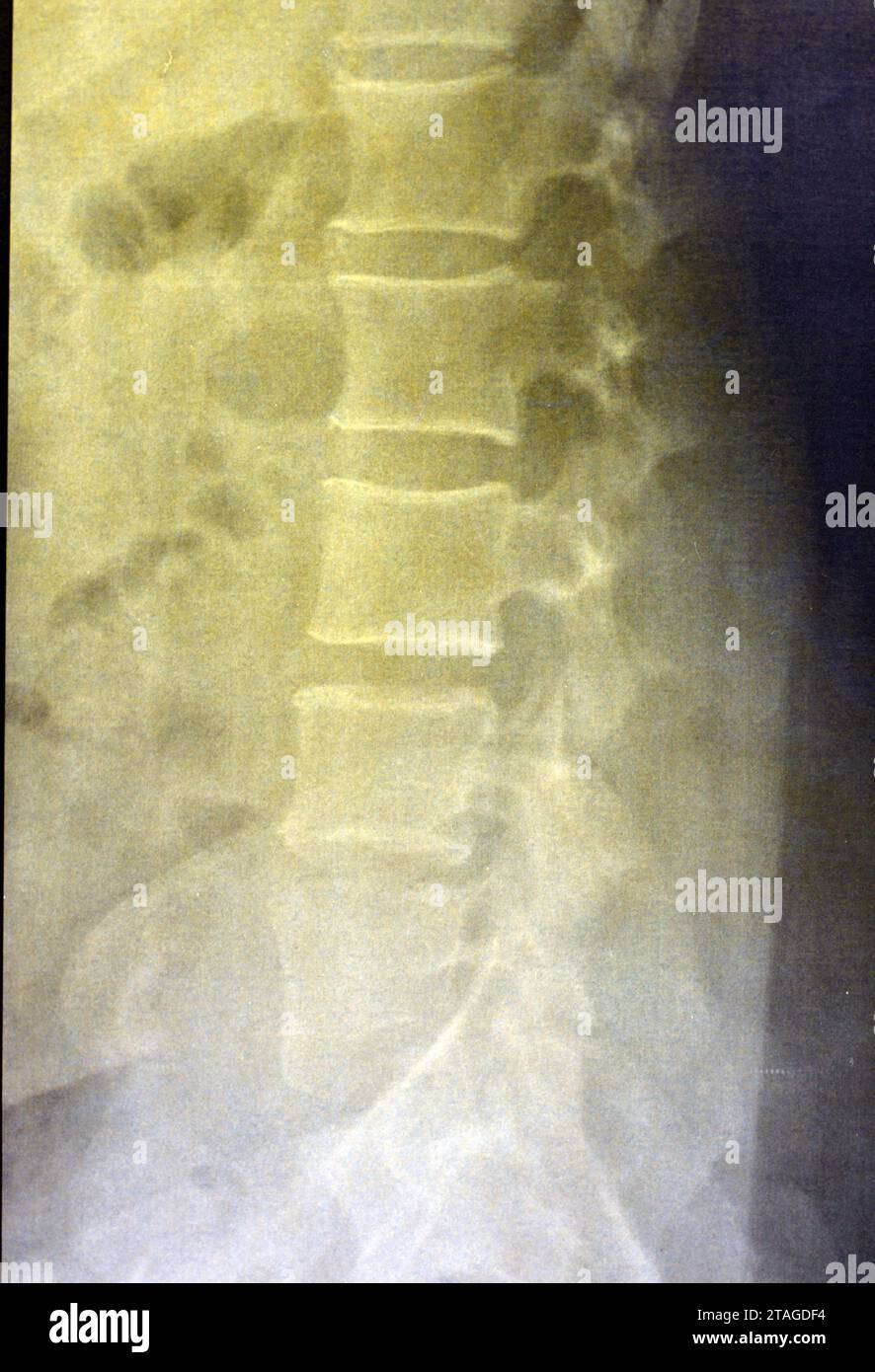 Plain X ray lumbosacral spine revealed straightened, mild scoliotic ...