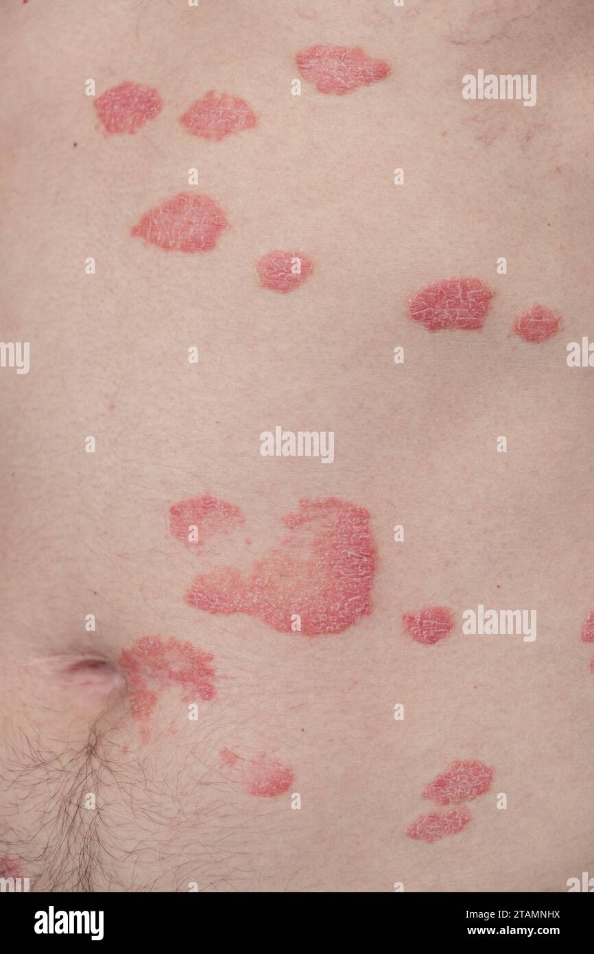 Psoriasis Vulgaris, skin patches are typically red, itchy, and scaly ...