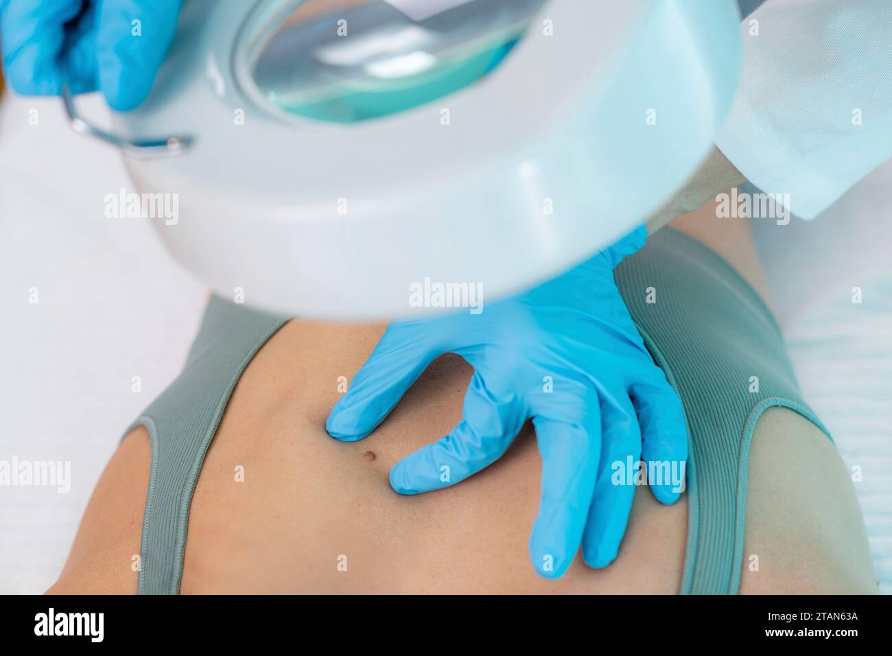 Dermatologist checking mole Stock Photo - Alamy