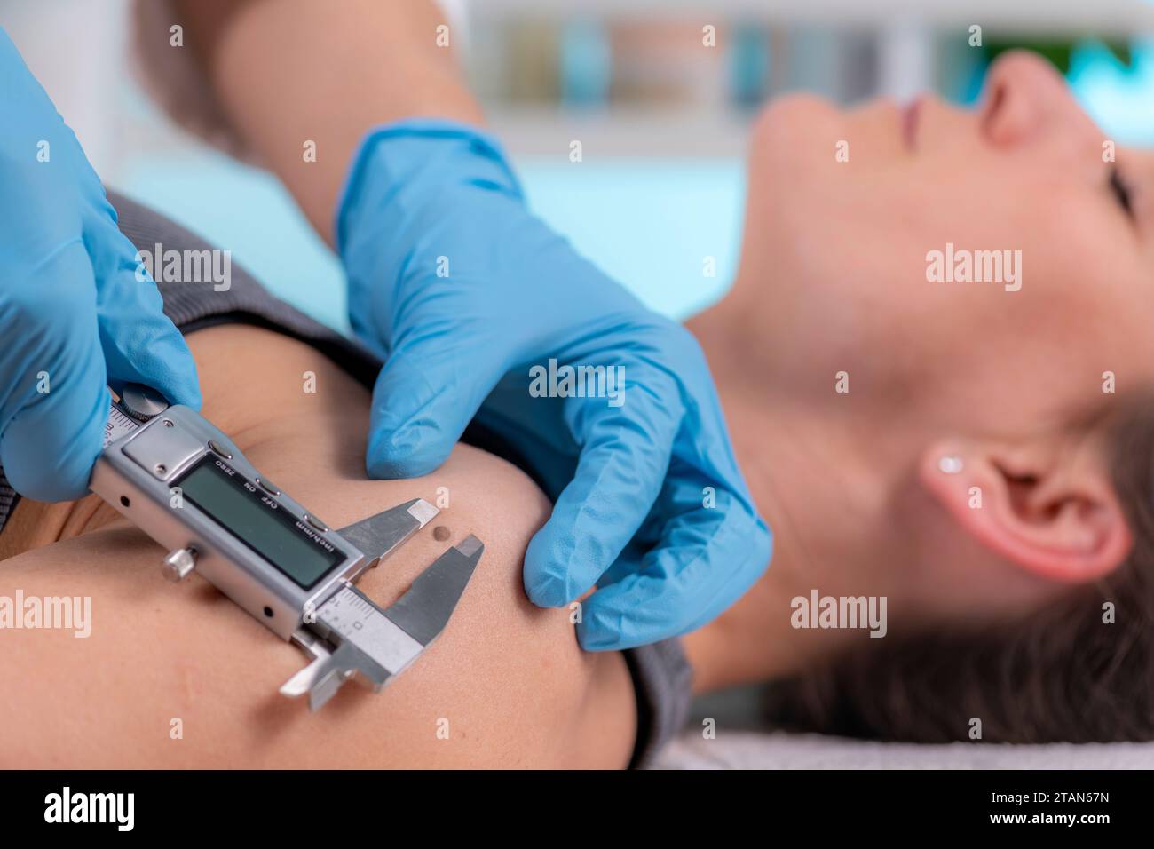 Dermatologist measuring mole Stock Photo - Alamy