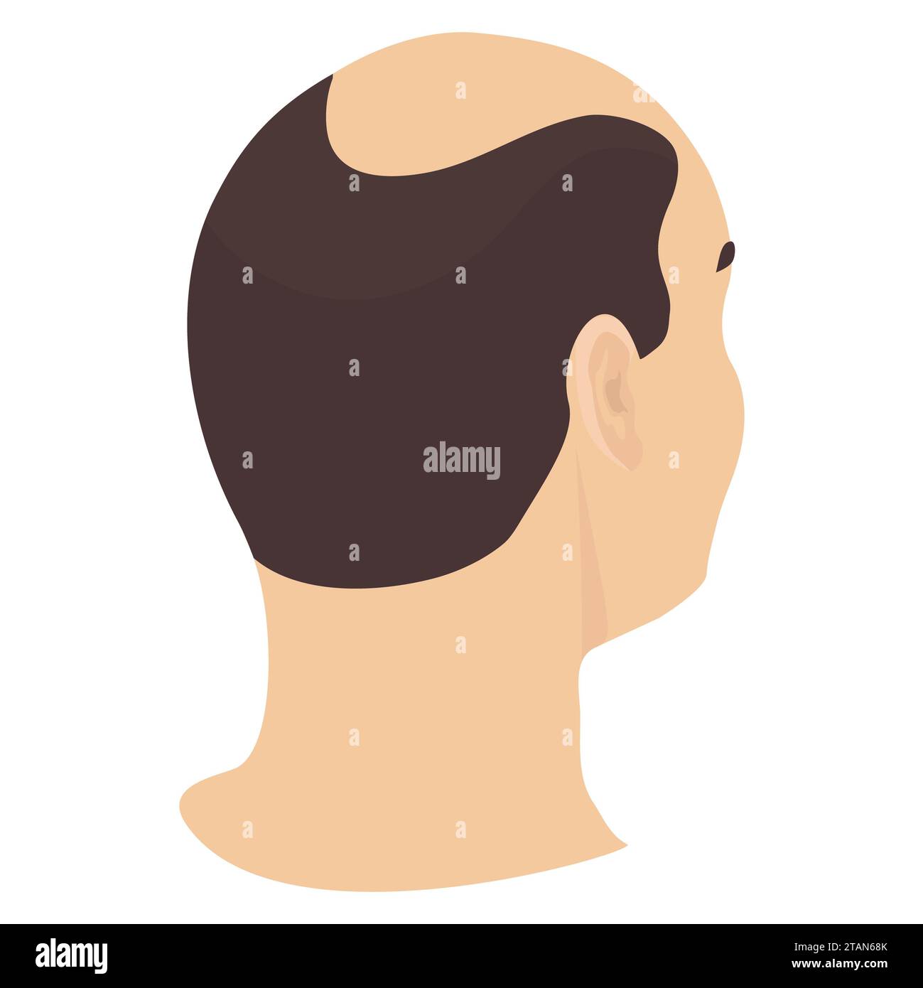 Alopecia in men hi-res stock photography and images - Alamy