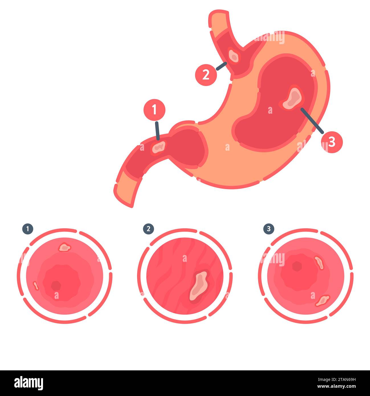 Peptic ulcer, conceptual illustration Stock Photo - Alamy