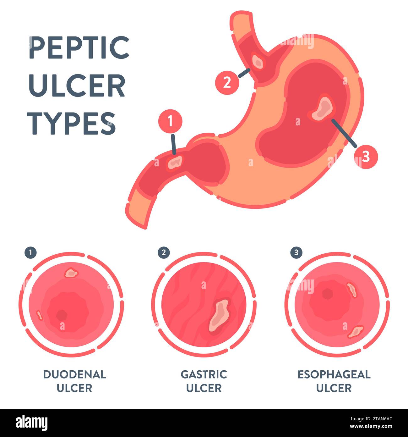 Peptic ulcer disease hi-res stock photography and images - Alamy