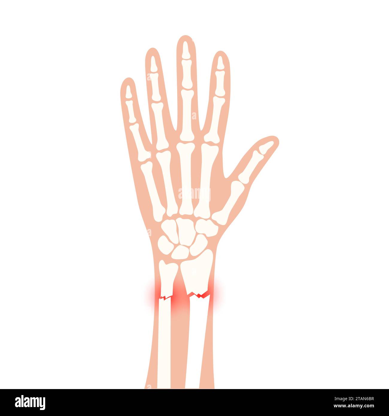 Fractured wrist, illustration Stock Photo - Alamy