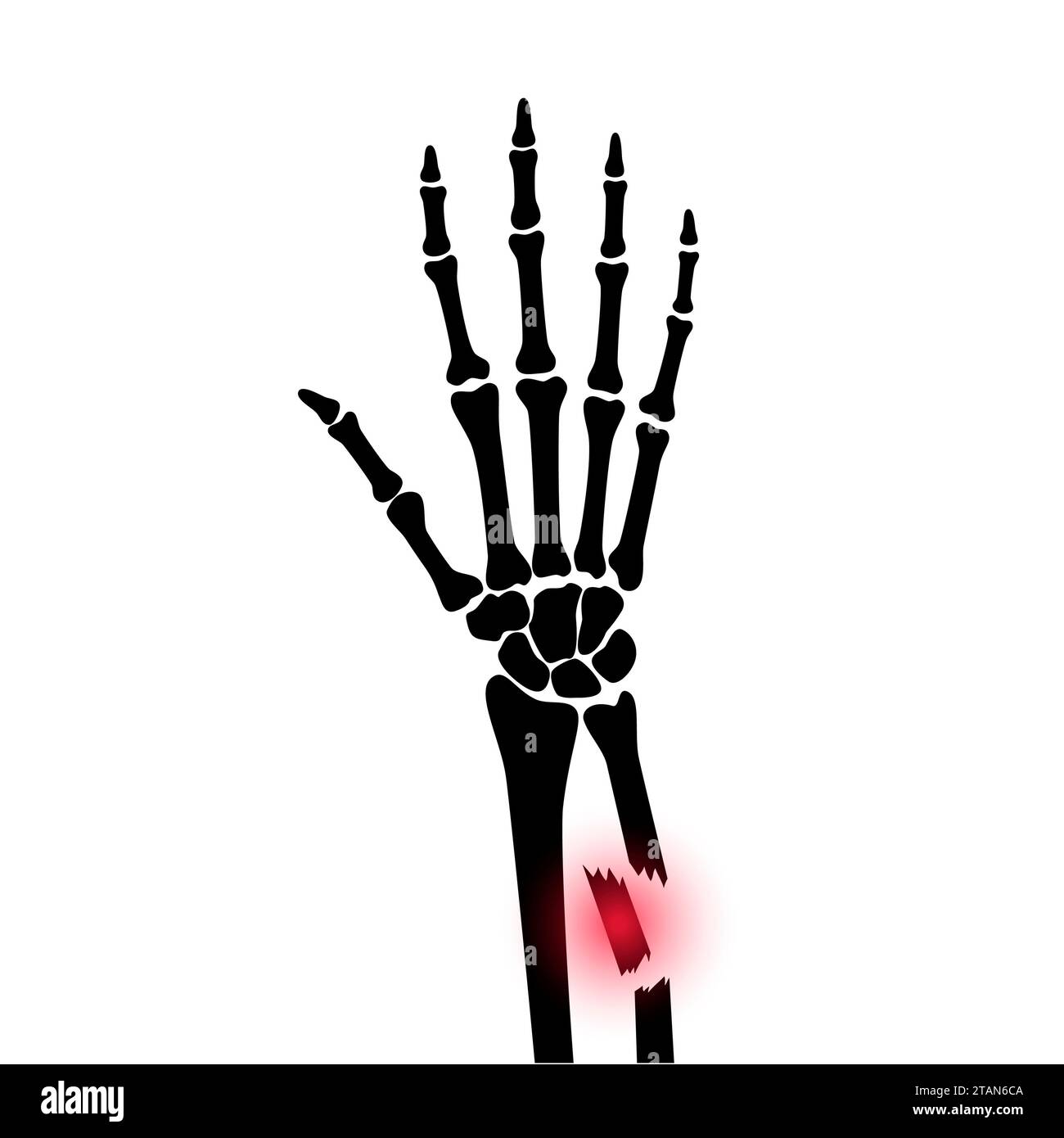 Fractured arm, illustration Stock Photo - Alamy