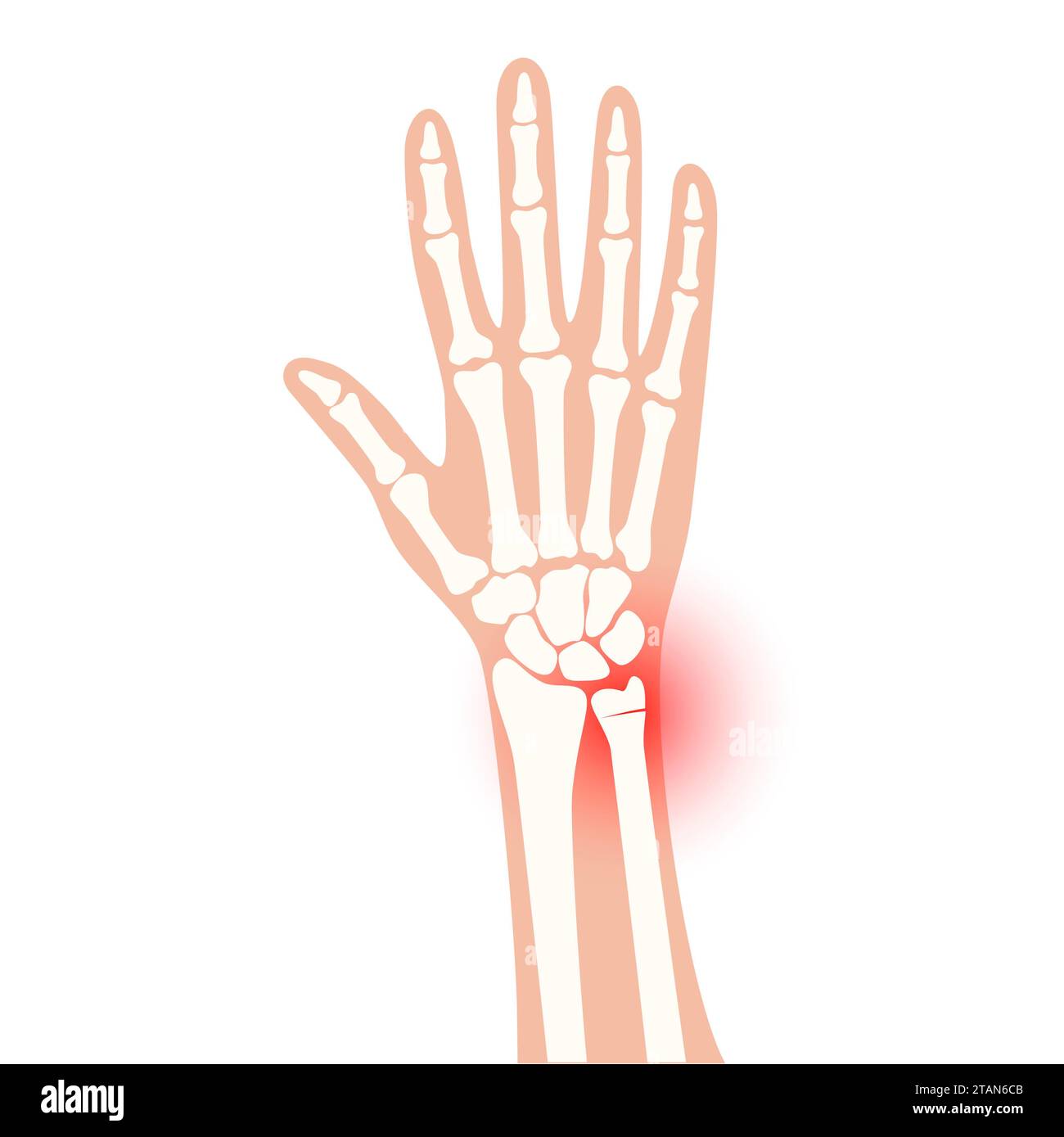 Fractured wrist, illustration Stock Photo - Alamy