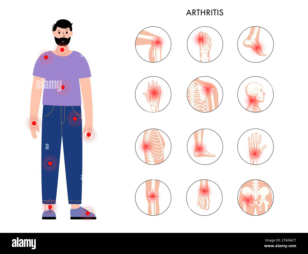 Arthritis knee joint Cut Out Stock Images & Pictures - Alamy