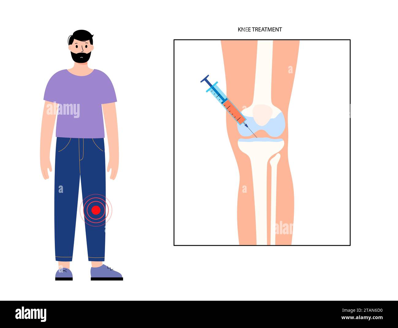 Injection for knee pain, illustration Stock Photo - Alamy