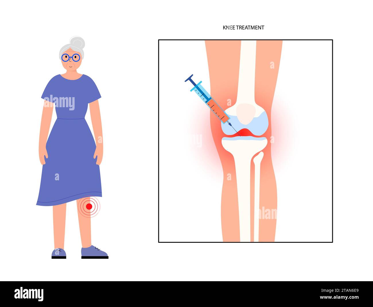 Injection for knee pain, illustration Stock Photo - Alamy