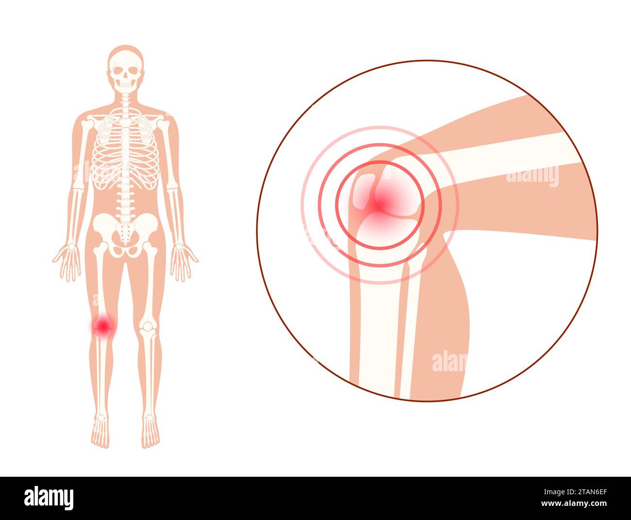 Knee pain, conceptual illustration Stock Photo - Alamy