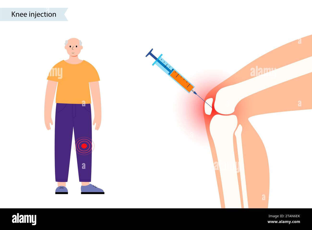 Injection for knee pain, illustration Stock Photo - Alamy
