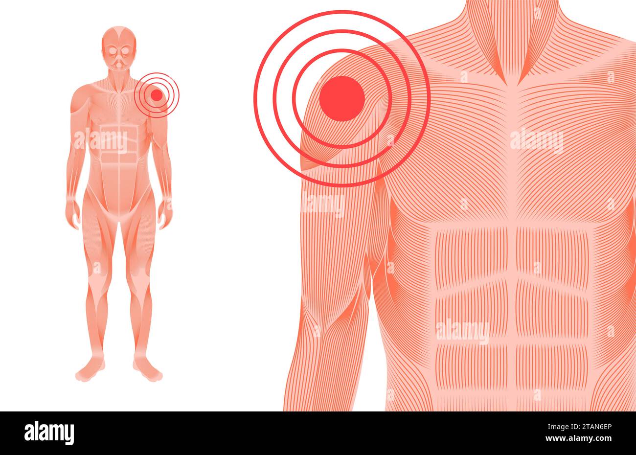 Shoulder pain, conceptual illustration Stock Photo - Alamy Shoulder pain, conceptual illustration Stock Photo - Alamy