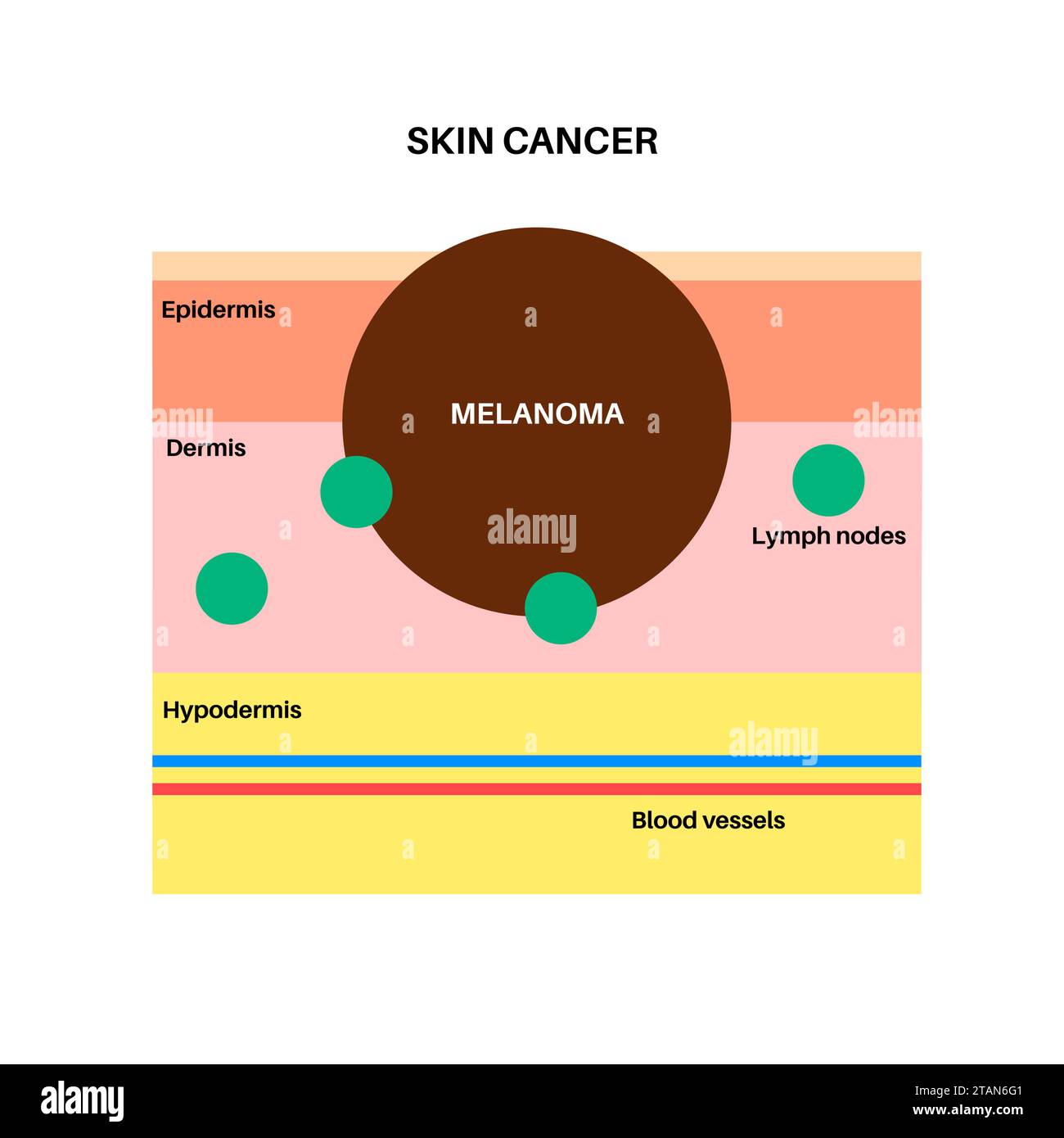 Skin cancer, illustration Stock Photo - Alamy