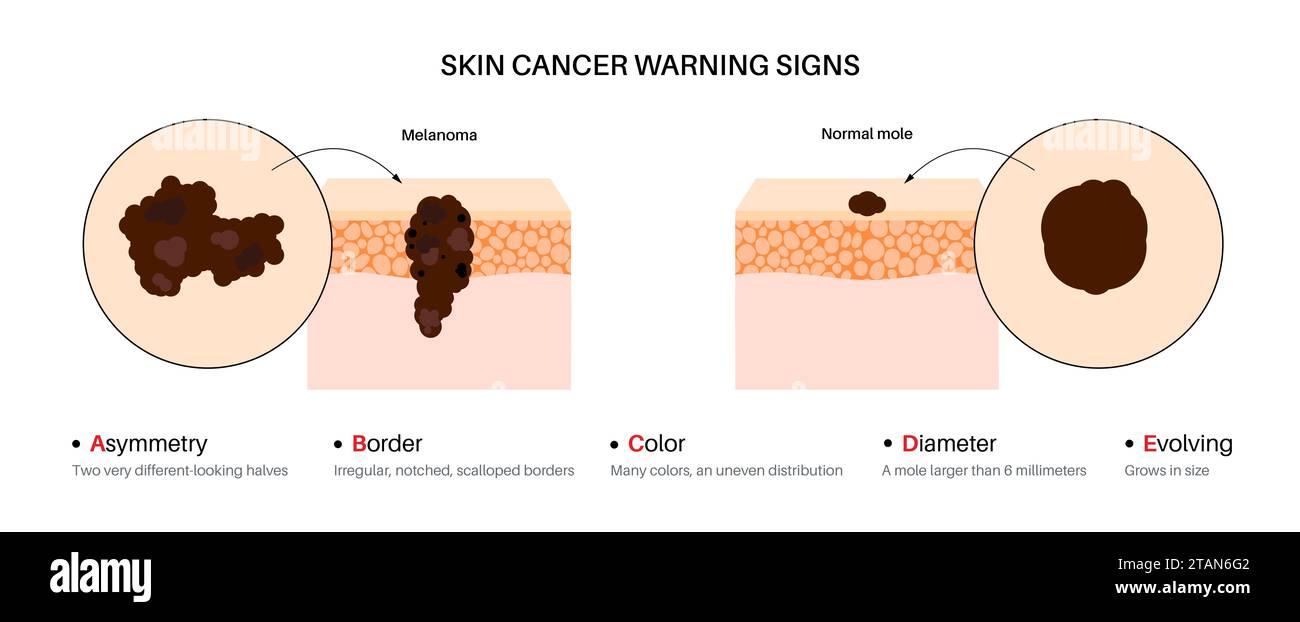 Melanoma warning signs, illustration Stock Photo - Alamy