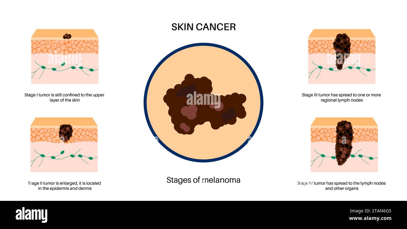 Melanoma stages, illustration Stock Photo - Alamy