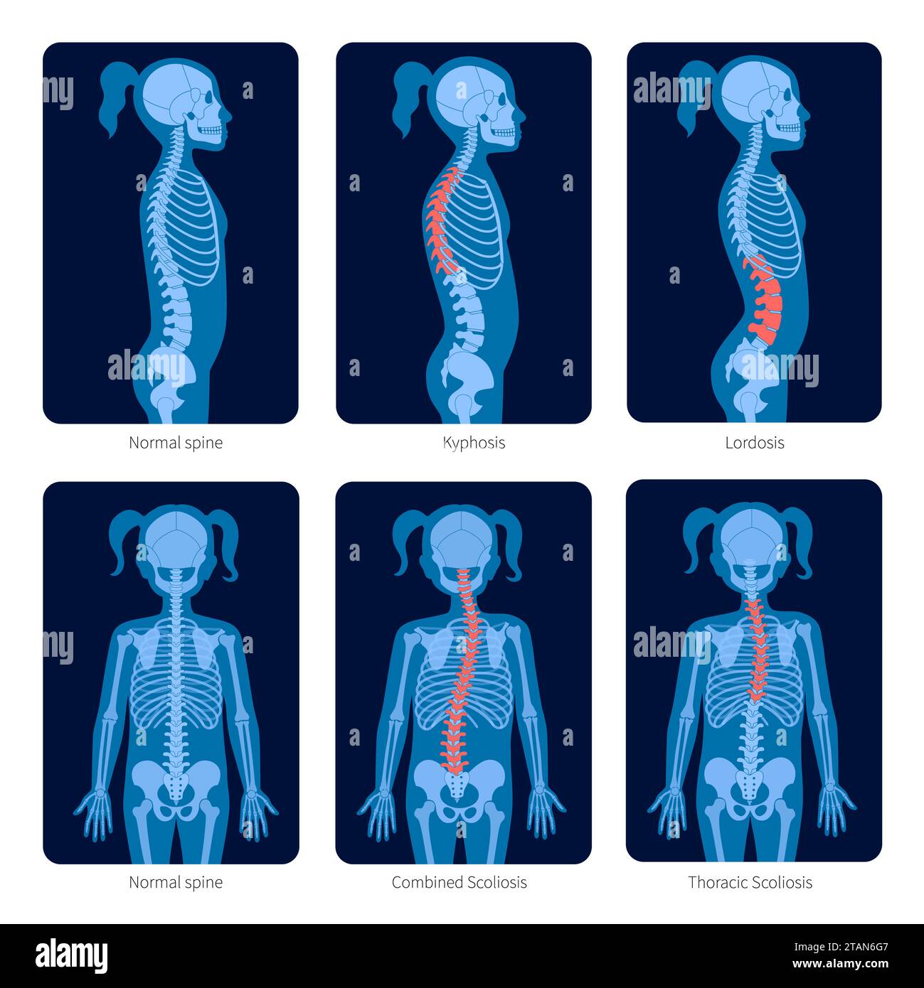 Healthy spine and scoliosis, illustration Stock Photo - Alamy