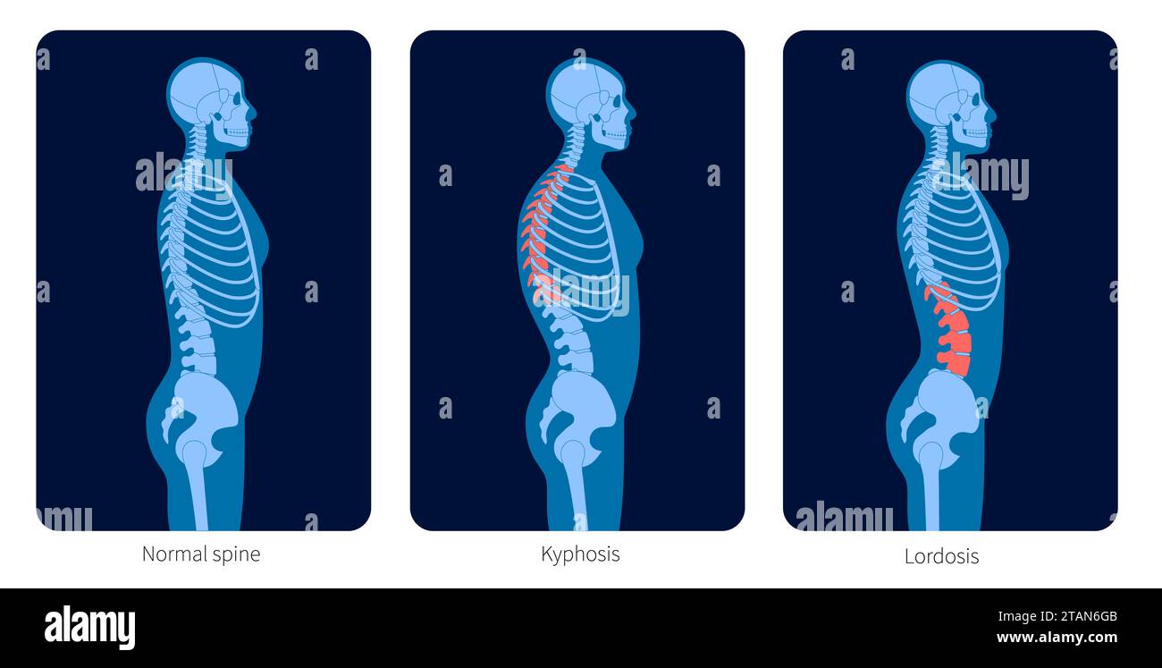 Healthy spine and scoliosis, illustration Stock Photo - Alamy