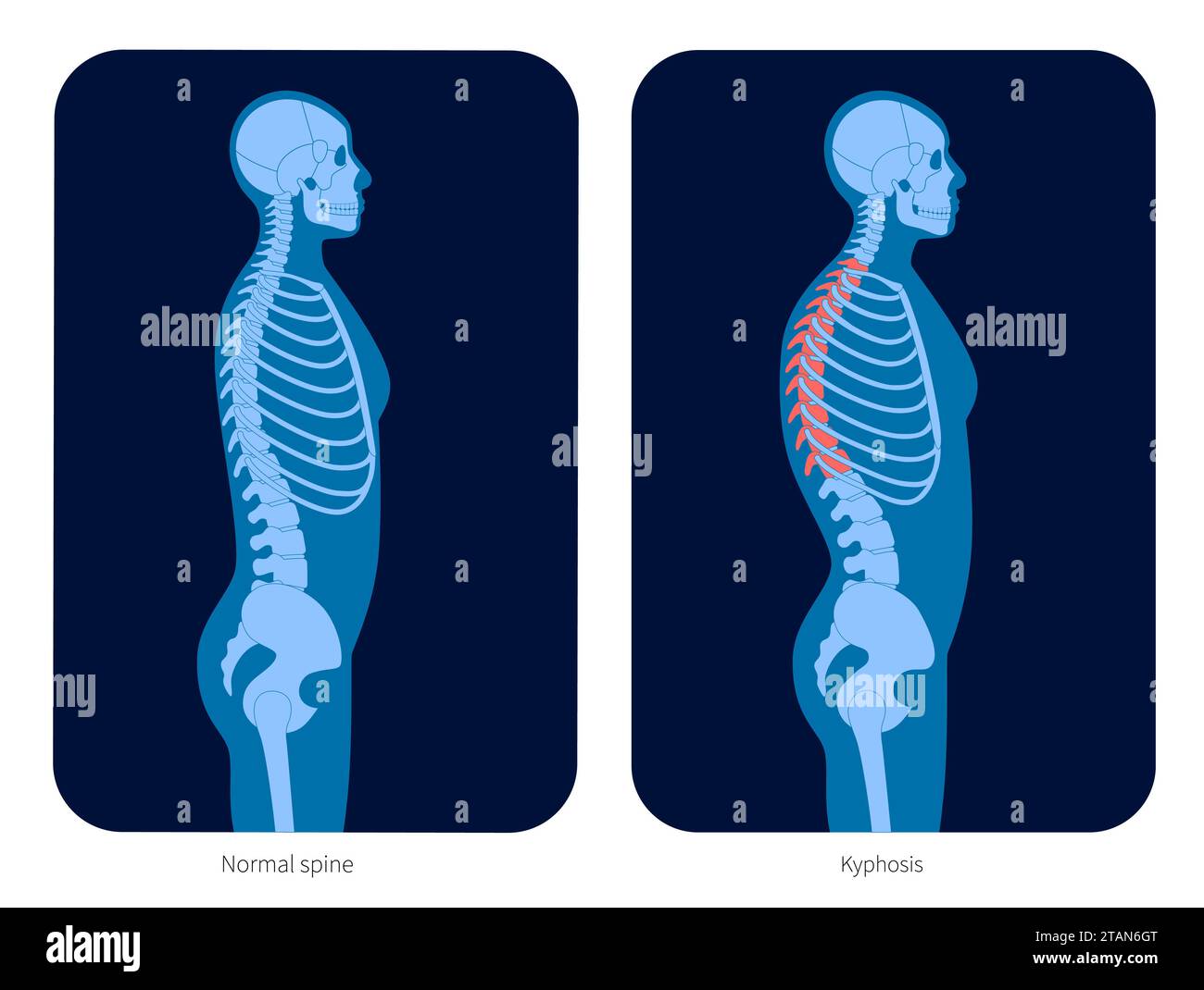Healthy spine and scoliosis, illustration Stock Photo - Alamy