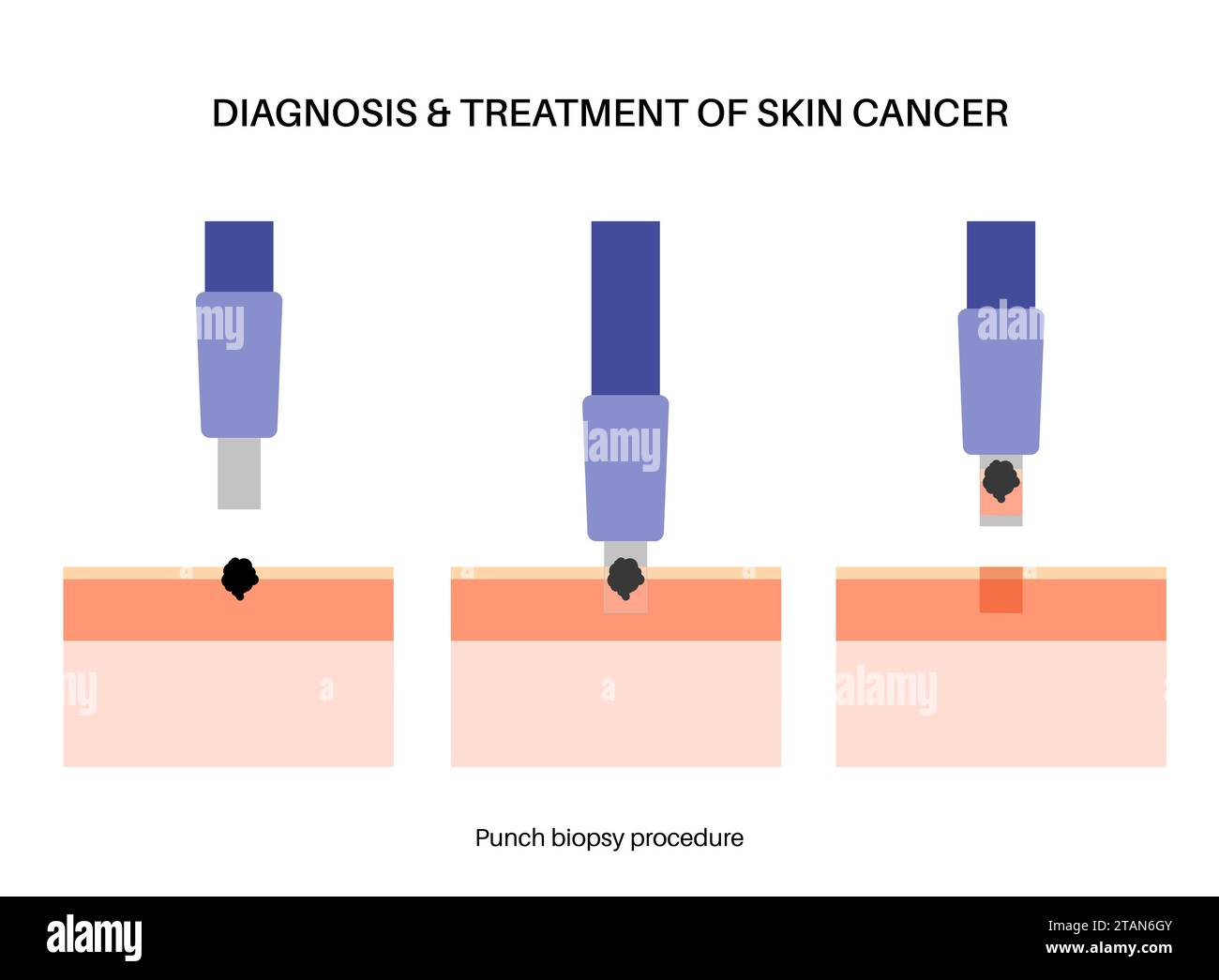 Skin biopsy hi-res stock photography and images - Alamy