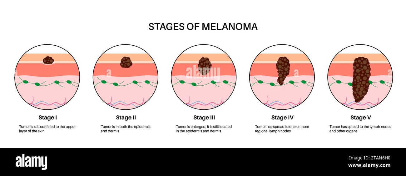 Melanoma stages, illustration Stock Photo - Alamy
