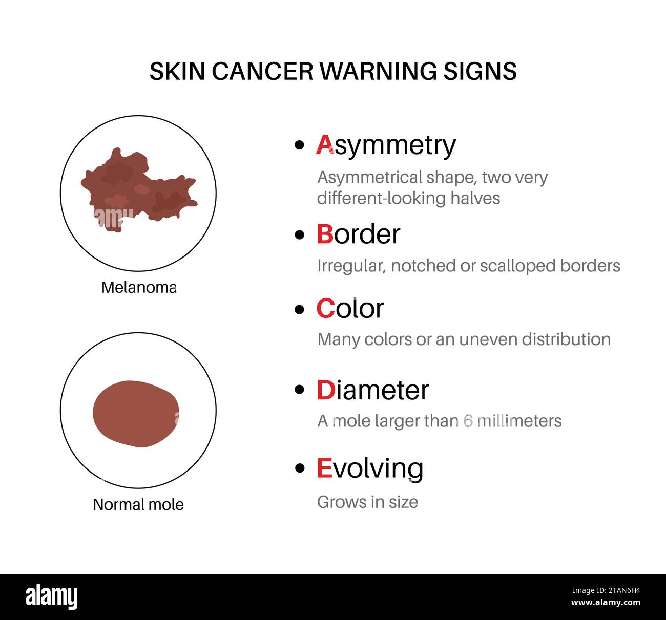 Melanoma warning signs, illustration Stock Photo - Alamy