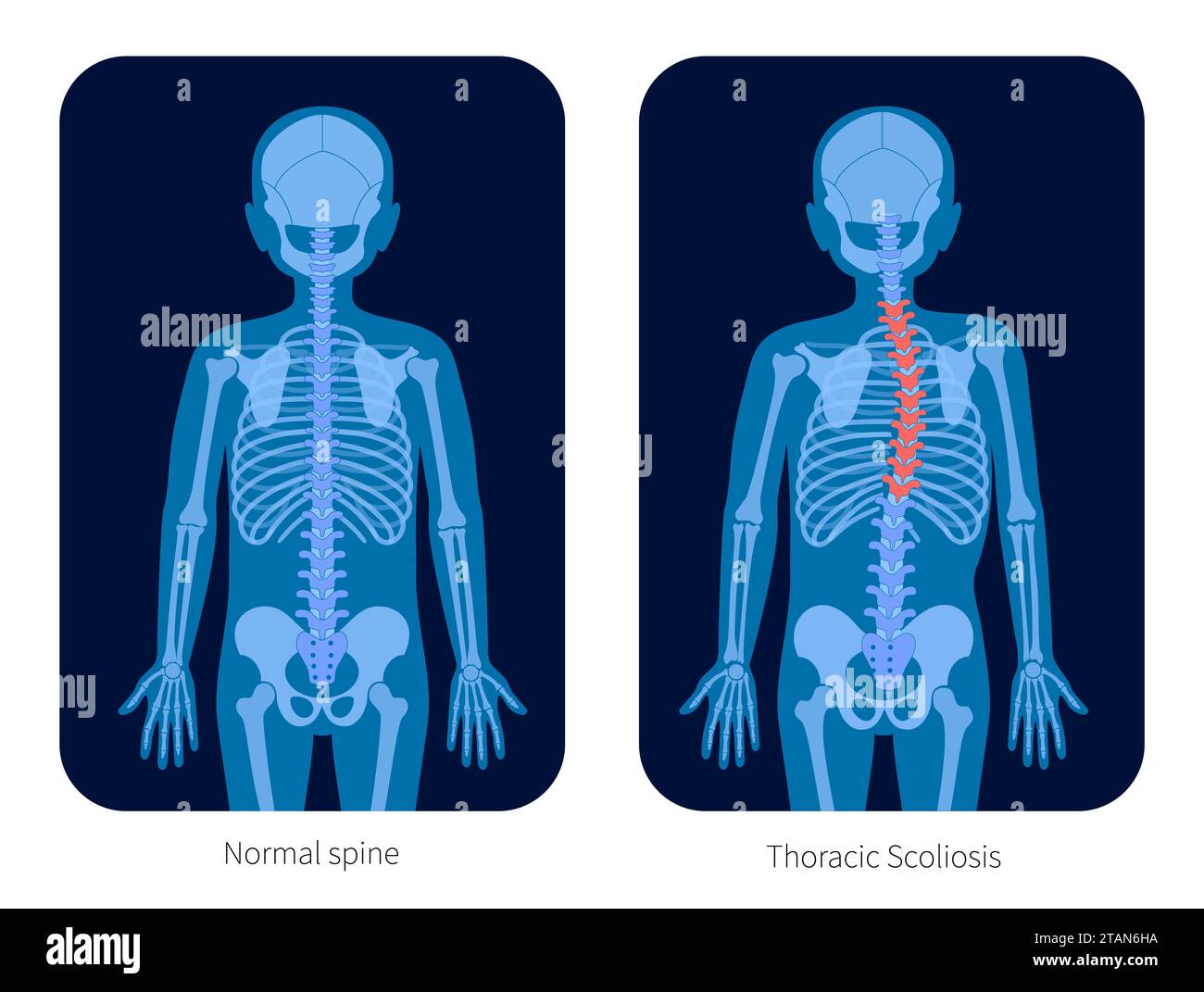 Healthy spine and scoliosis, illustration Stock Photo - Alamy