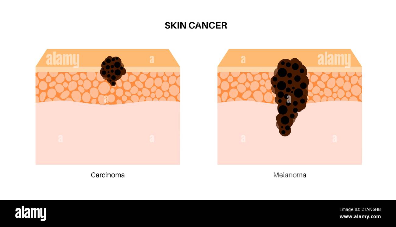 Skin cancer, illustration Stock Photo - Alamy