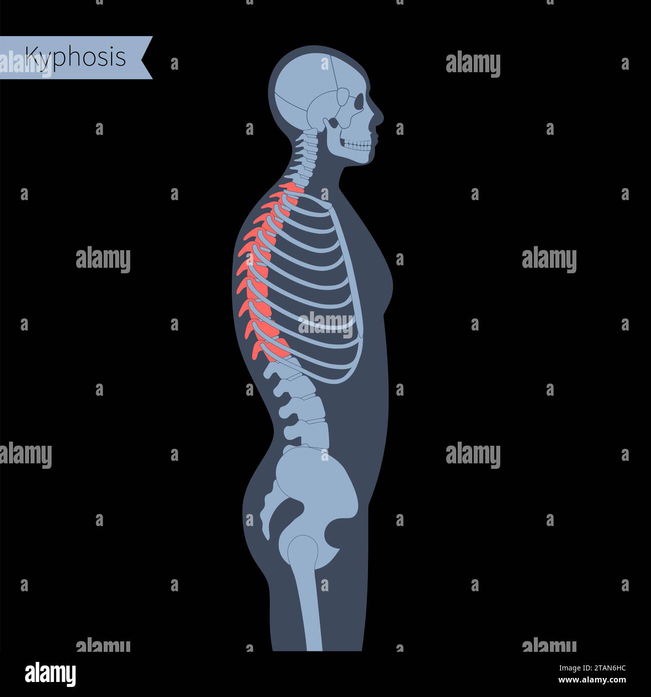 Scoliosis and kyphosis hi-res stock photography and images - Alamy