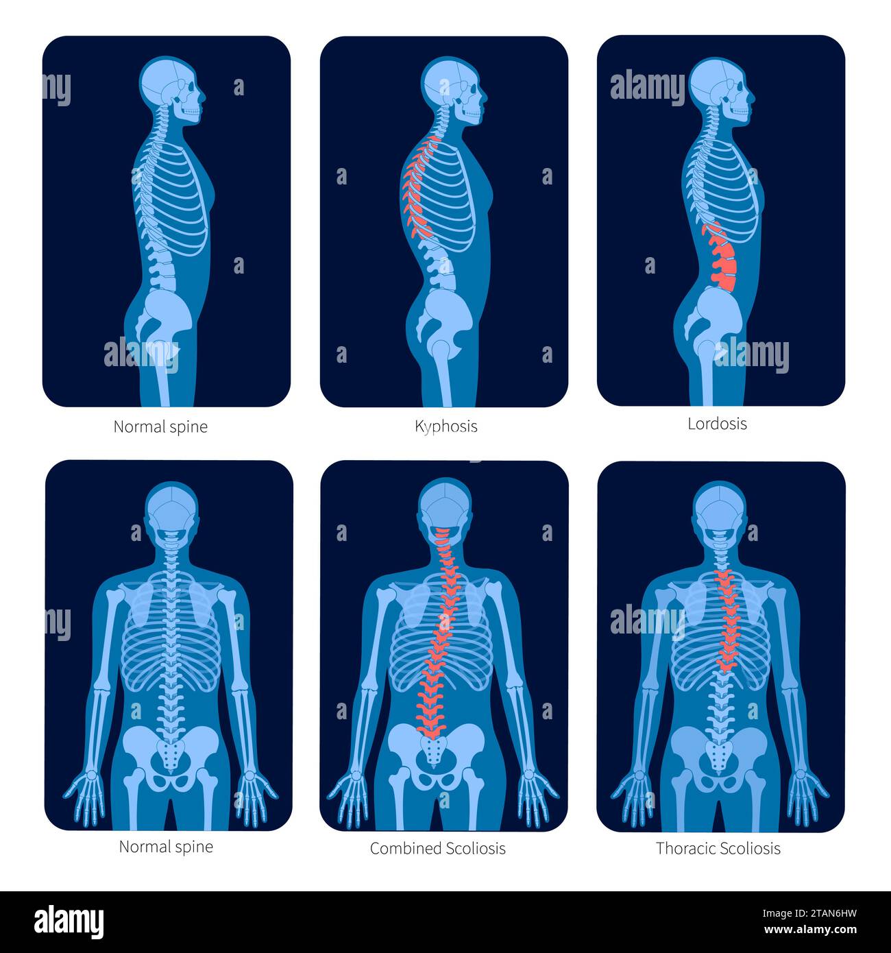 Cervical lumbar lordosis hi-res stock photography and images - Alamy