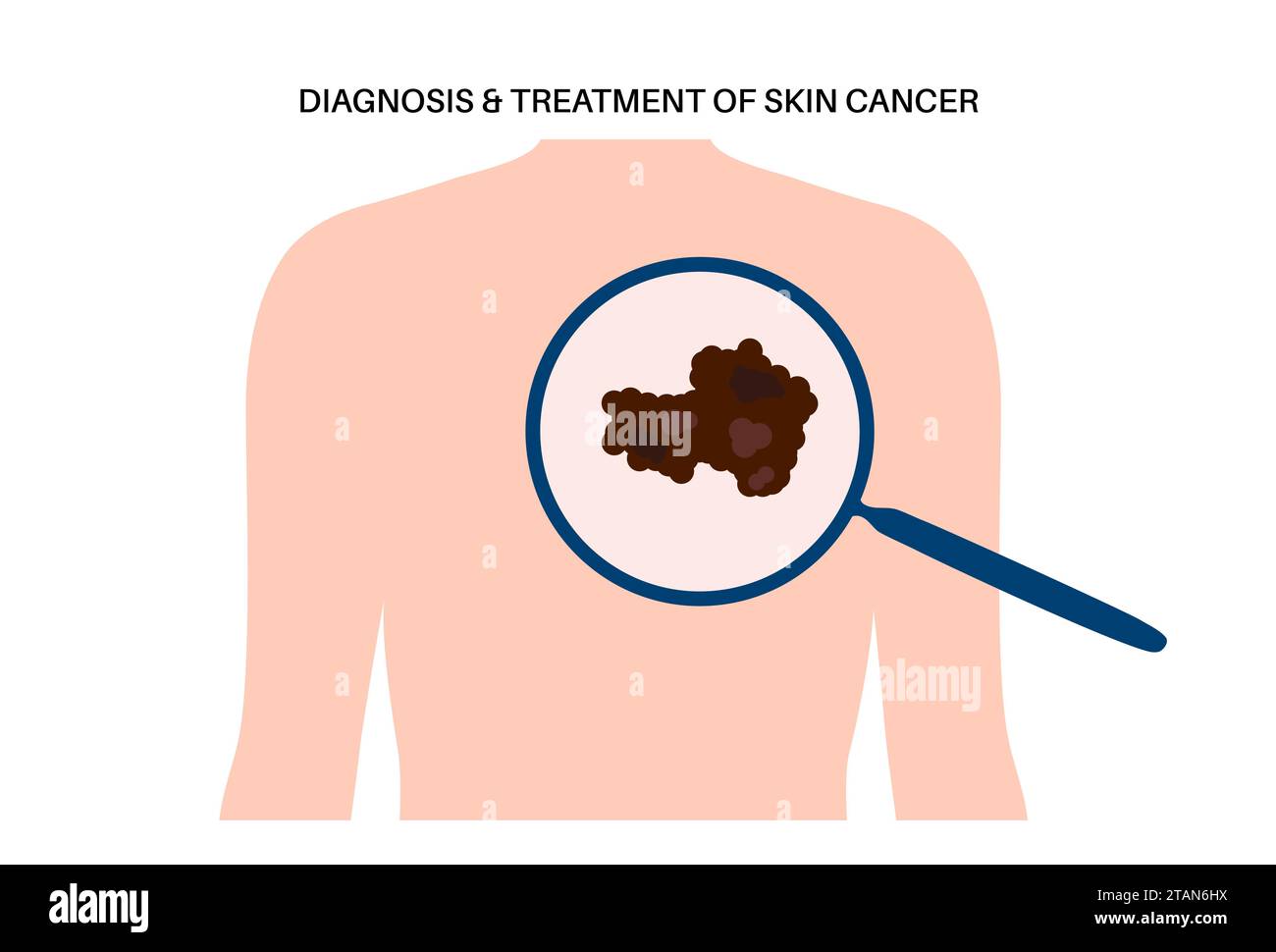 Skin cancer, illustration Stock Photo - Alamy