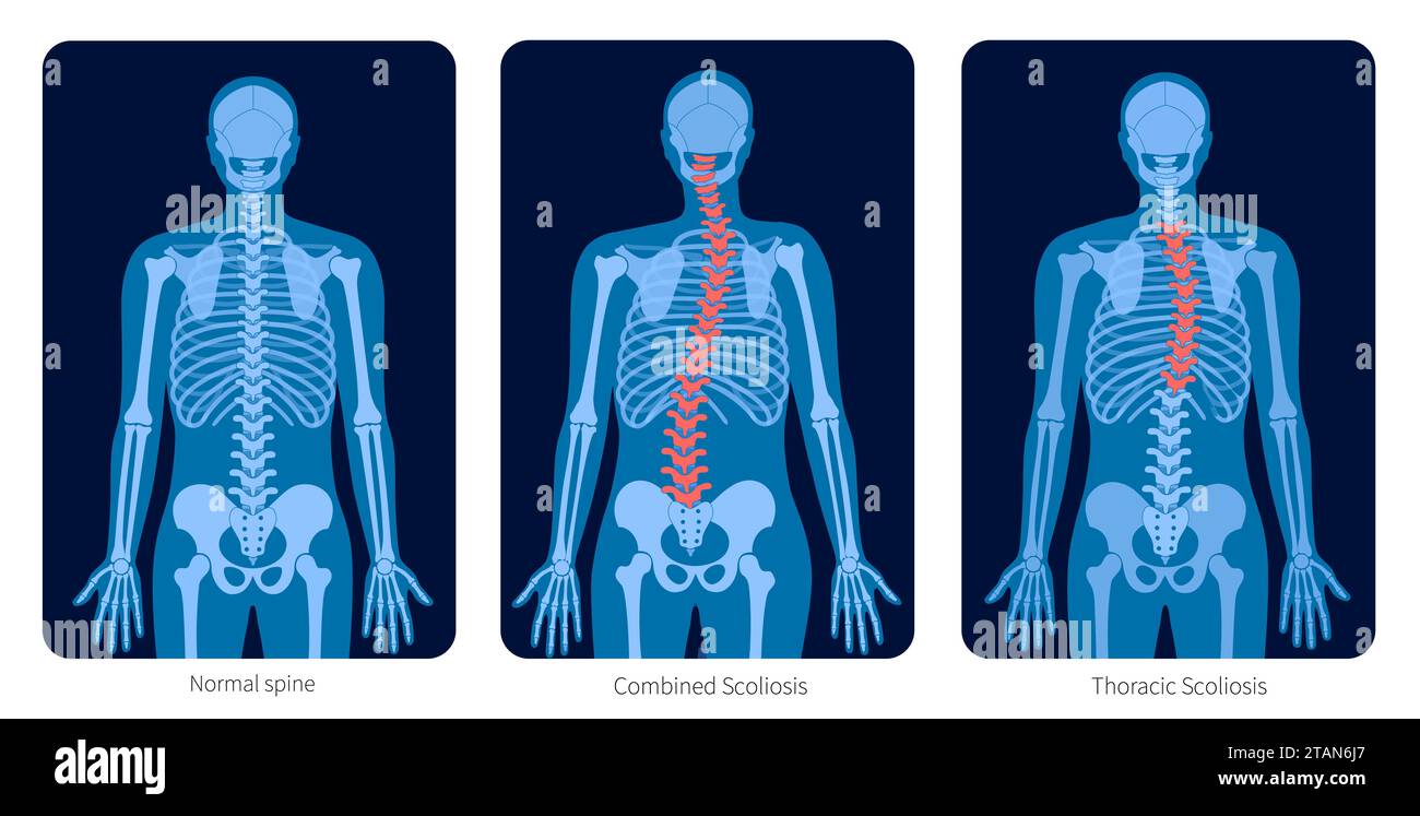 Healthy spine and scoliosis, illustration Stock Photo - Alamy