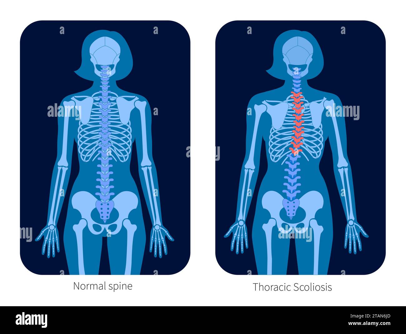 Scoliosis spine curve anatomy hi-res stock photography and images - Alamy