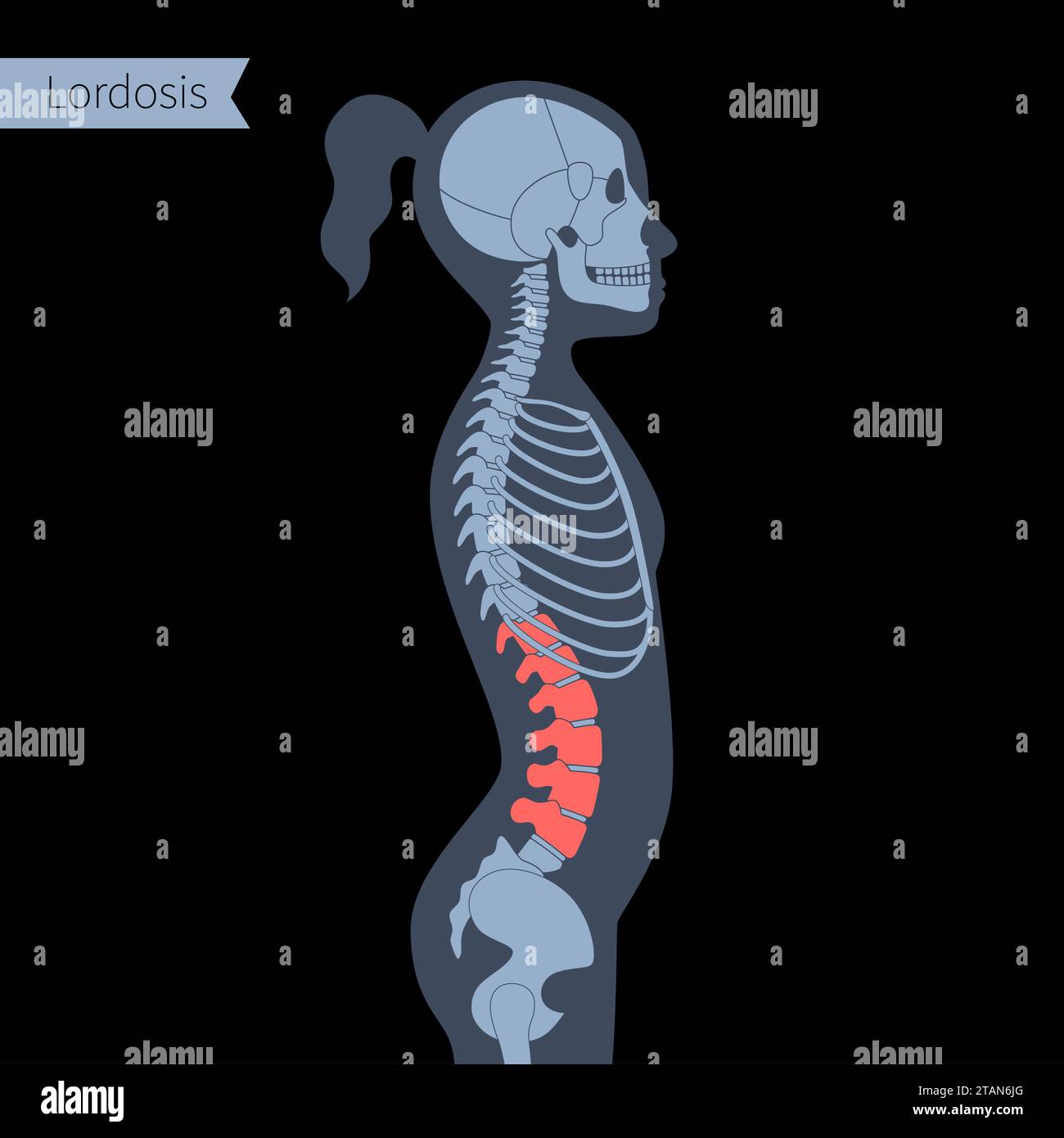 Scoliosis children hi-res stock photography and images - Alamy