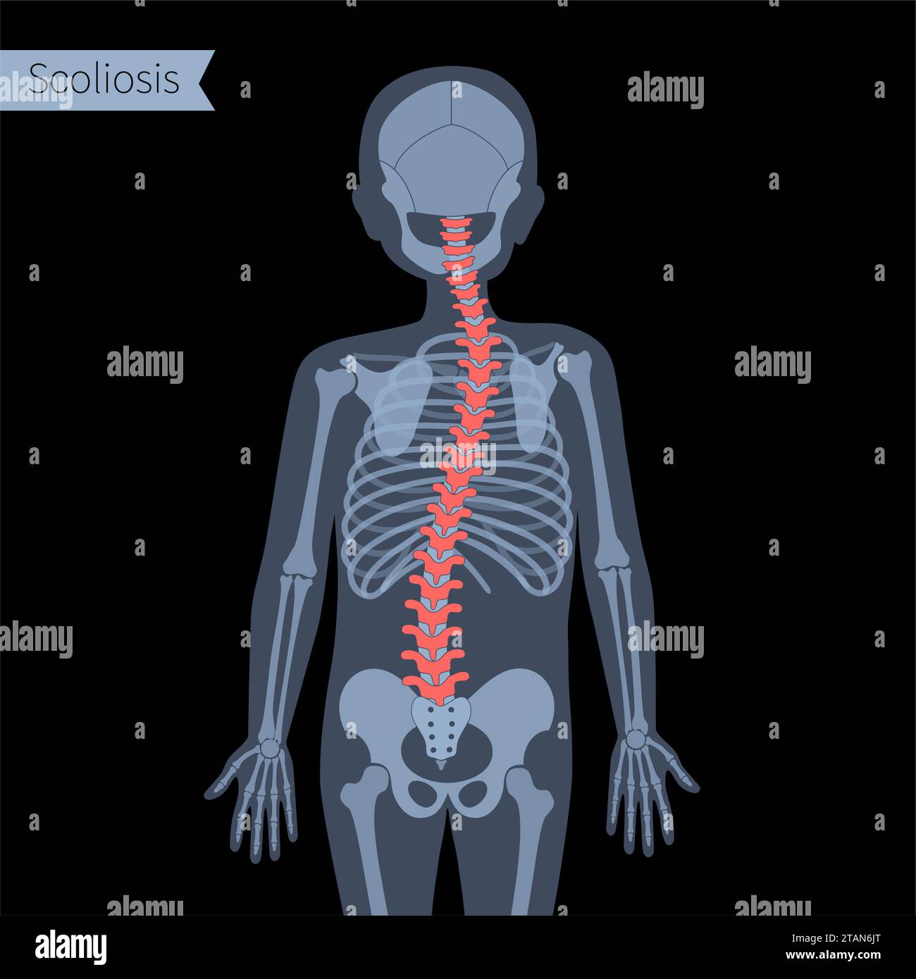 Scoliosis children hi-res stock photography and images - Alamy