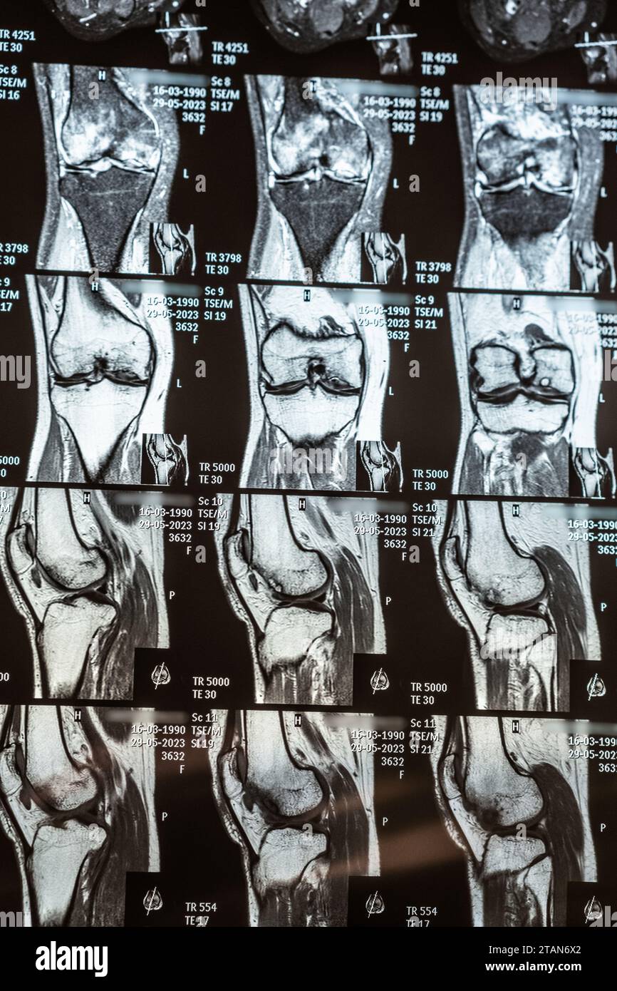 Magnetic resonance imaging of human knee joint for medical diagnosis ...