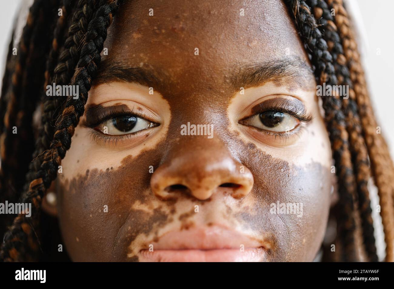 African vitiligo face hi-res stock photography and images - Alamy